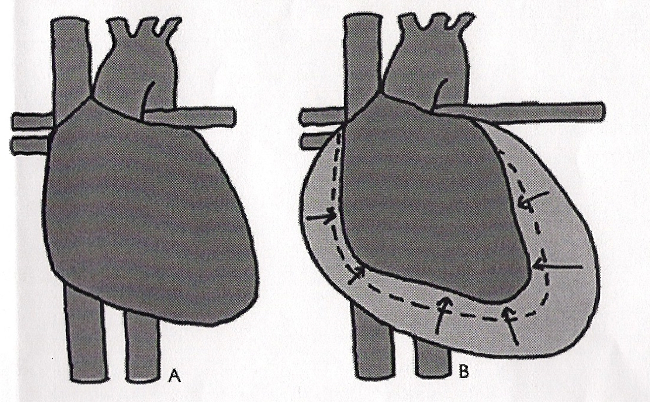 Ontsteking van het hartzakje; pericarditis | Bravis