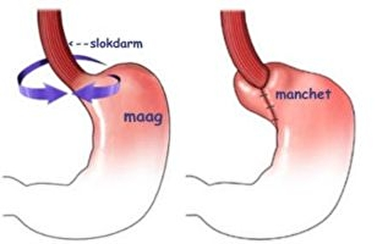 Operatie bij refluxziekte (robot geassisteerde-laparoscopische Nissen ...