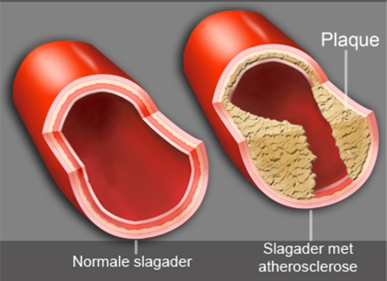 Vaatproblemen aan de slagaderen (arterieel vaatlijden) | Bravis