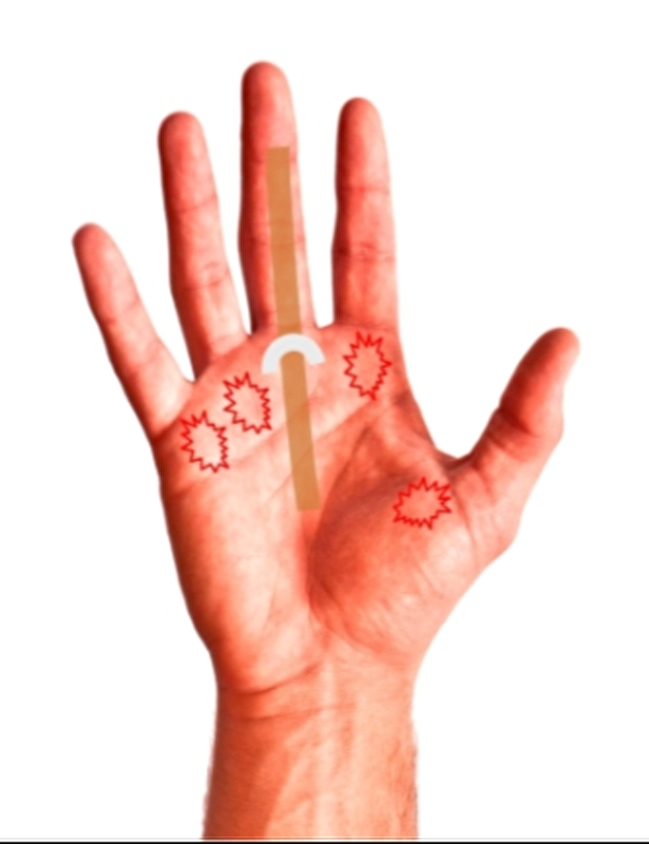 Trigger finger; hokkende vinger | Bravis