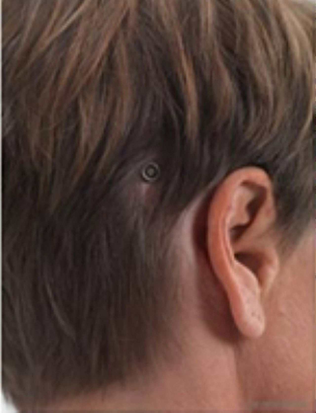 BCD Bone Conduction Device | Bravis