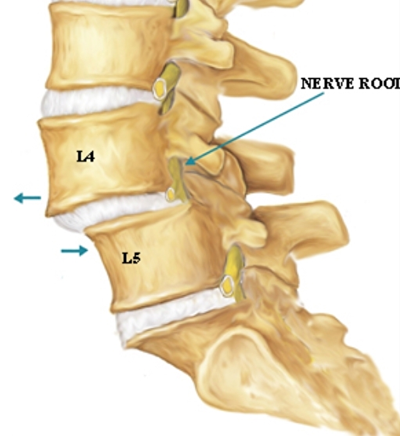 Vastzetten van de rugwervels; lumbale spondylodese | Bravis