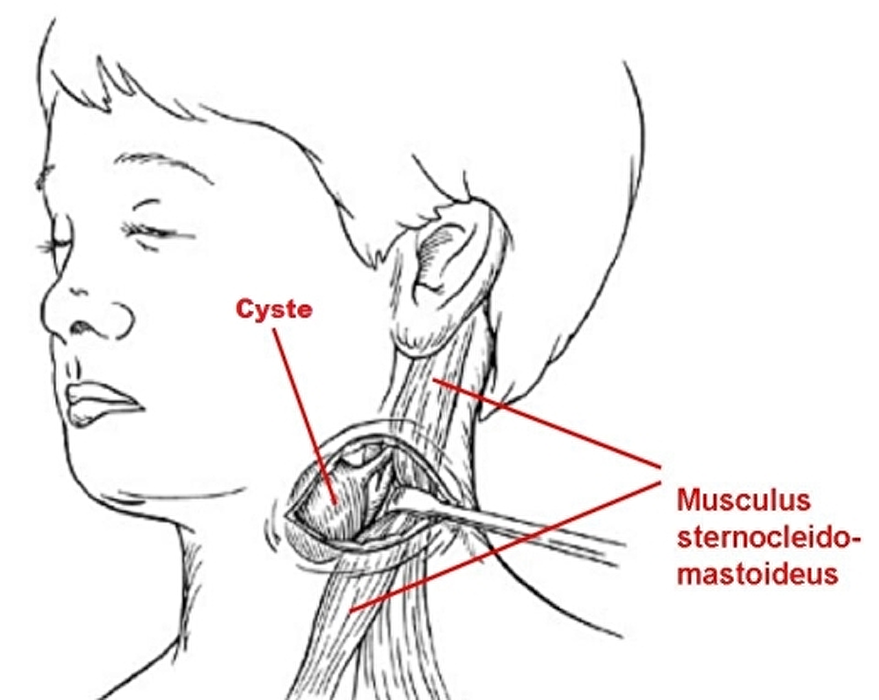 Halscyste operatie (laterale/mediane) | Bravis