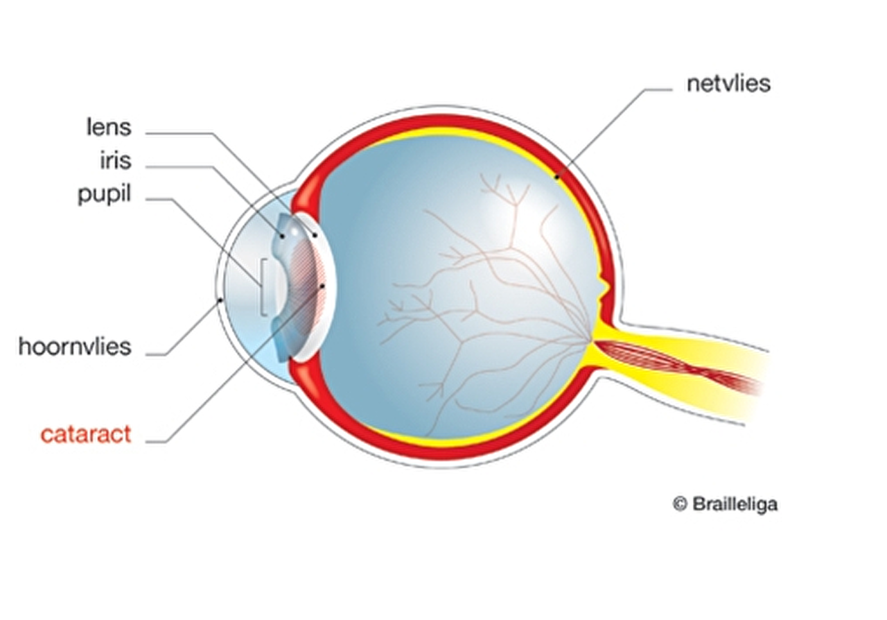 Staaroperatie | Bravis