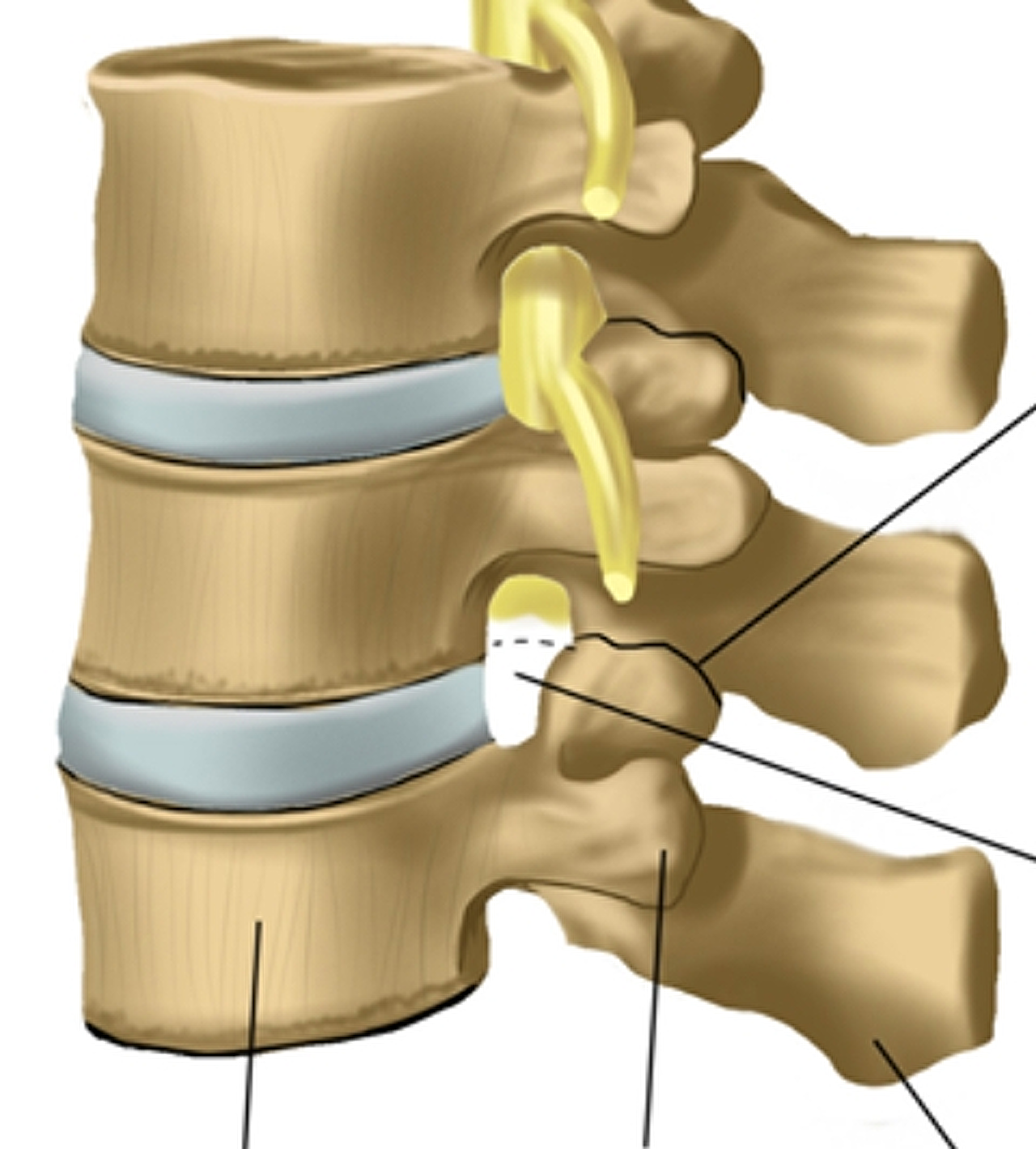 Vastzetten van de rugwervels; lumbale spondylodese | Bravis