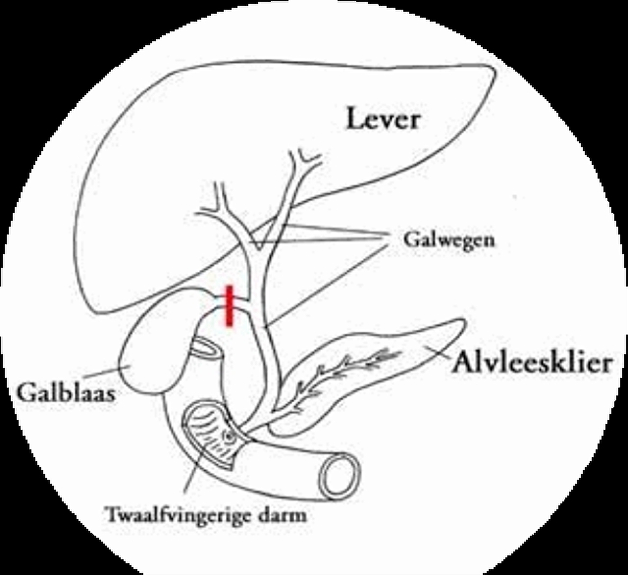 Galblaasoperatie (cholecystectomie) | Bravis
