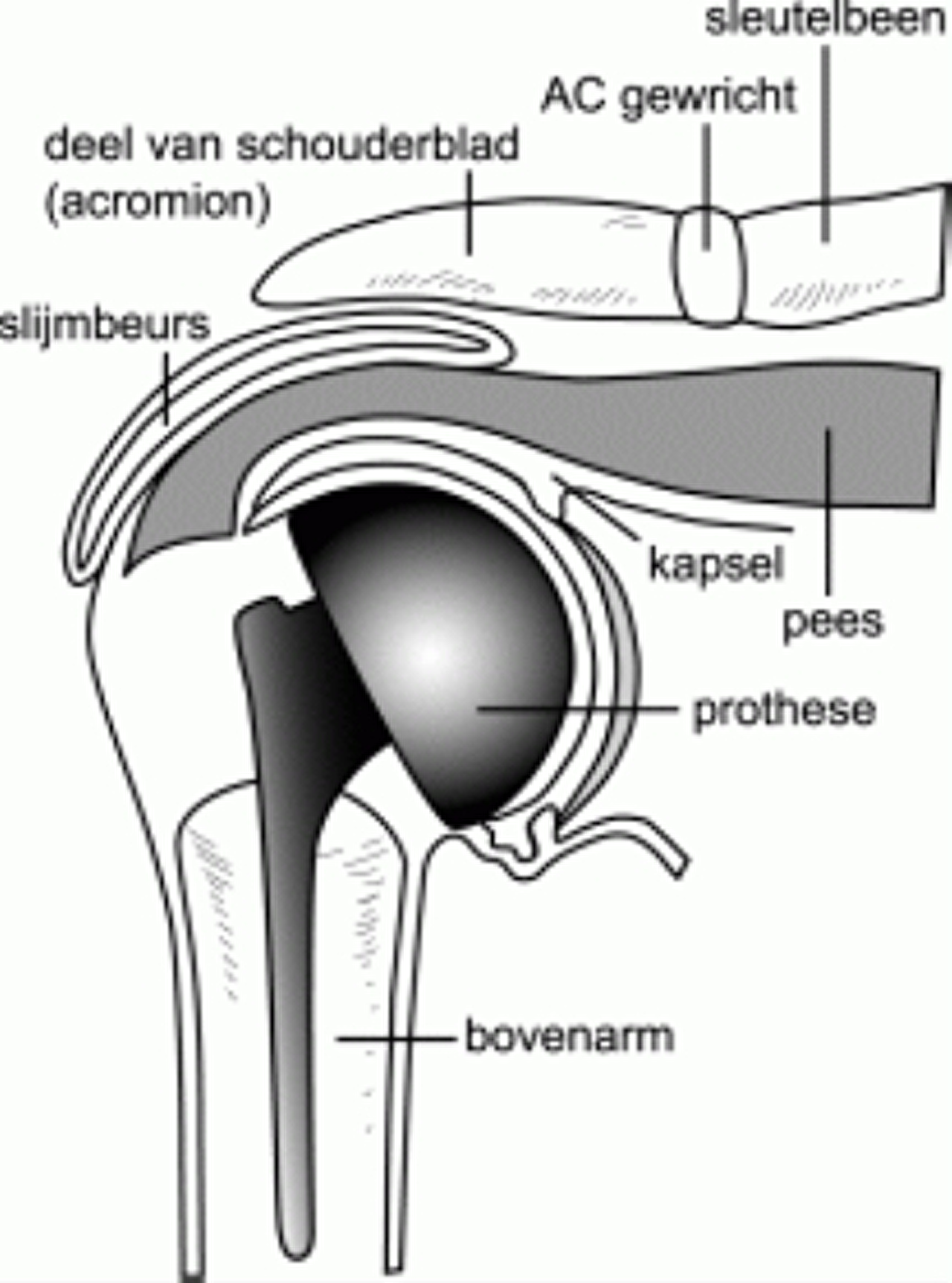 Schouderprothese | Bravis